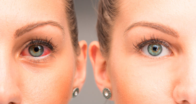 LA UVEITIS COMO PRINCIPAL CAUSA DE CEGUERA - Baja visión y ...